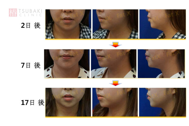 FatX core脂肪溶解注射の経過を知るためのガイド - 銀座・名古屋・心斎橋の美肌治療は椿クリニック